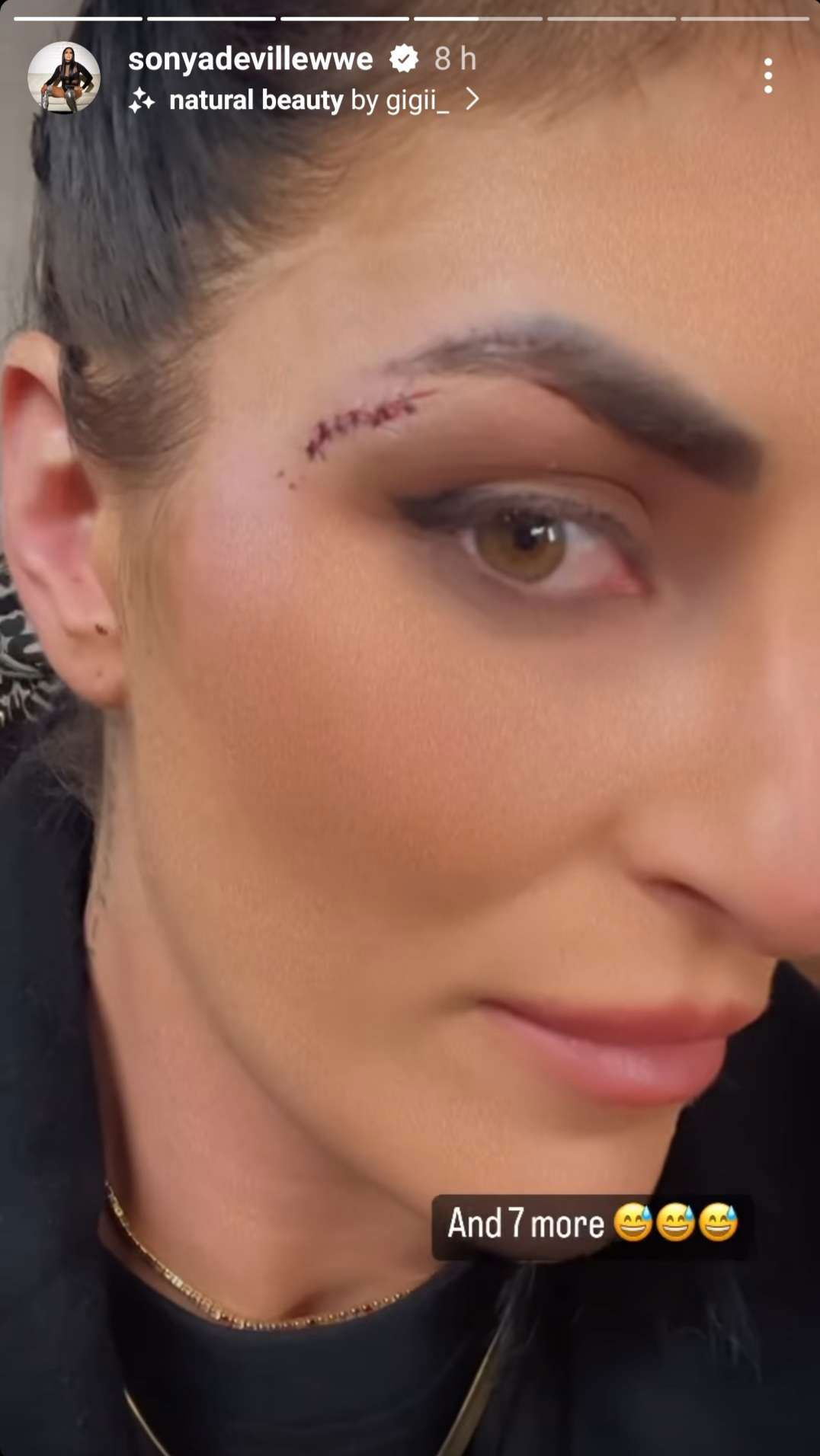 PHOTOS: WWE Star Gets Stitches After Accidental Face Injury - WrestleTalk