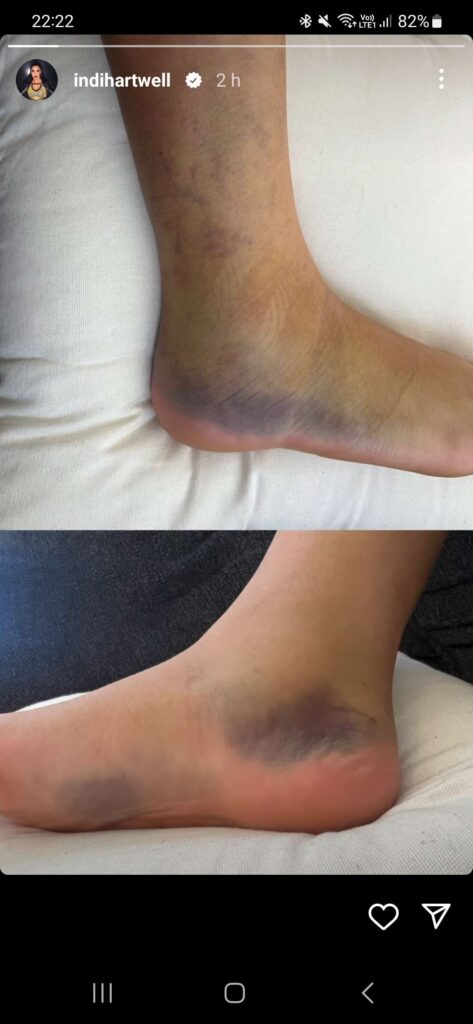 Indi Hartwell Shares Photo Of Injury - WrestleTalk
